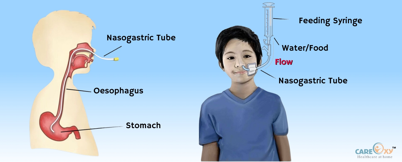 Foley Catheterisation Complete Procedure - Nurse For Home